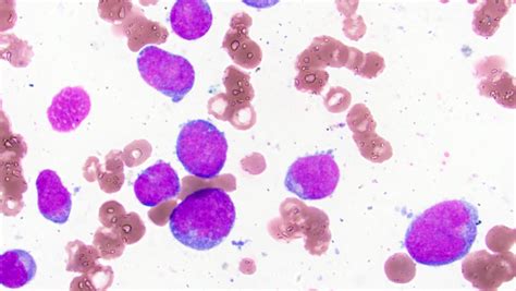 Acute Monocytic Leukemia An Overview Sciencedirect Topics 59 Off