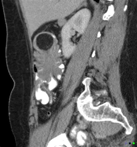 Lipoma In The Colon Causing Colocolic Intussusception Pacs