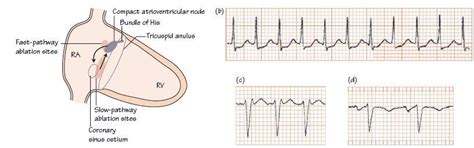 Atrioventricular Nodal Re Entrant Tachycardia Thoracic Key