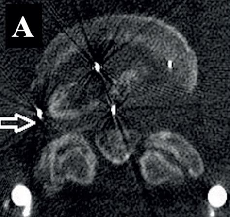 Images From Optical Navigation Use In Endoscopic Spine Surgery A The Download Scientific
