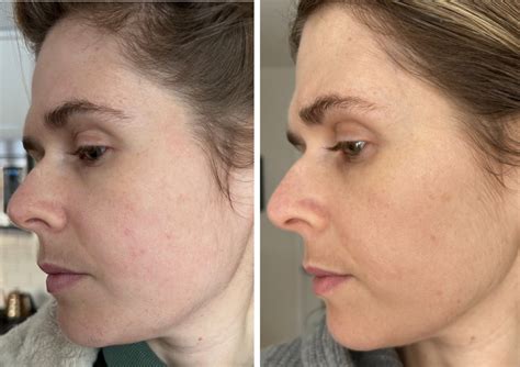 A Beginners Guide To Natural Retinol With Before And After Pics The