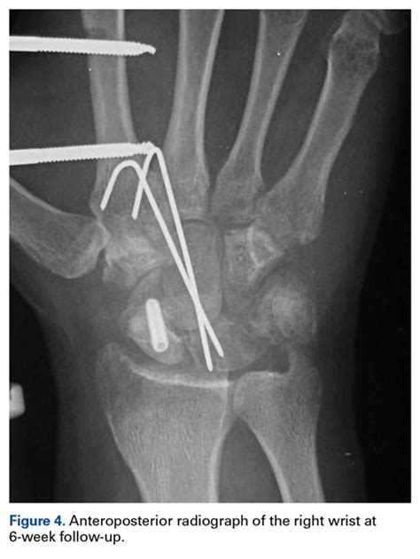 Capitate Dislocation Treatment