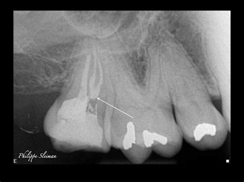 Dental News Clinical Management Of Maxillary Second Molar Root Canal Therapy In Different