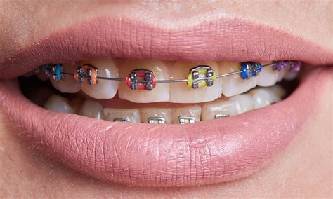 Ortodoncia Con Brackets En Alicante Clínica Dental Novodent