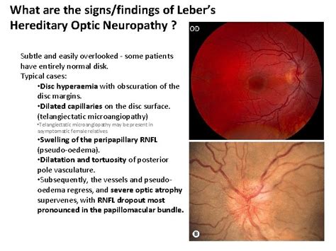 What Is Leber Hereditary Optic Neuropathy At Lauren Blackwell Blog