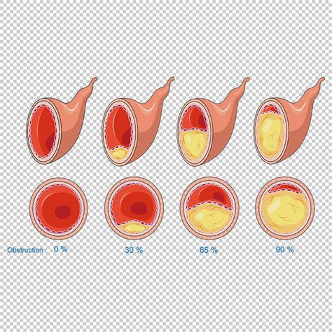 Atheroma Obstruction Vector