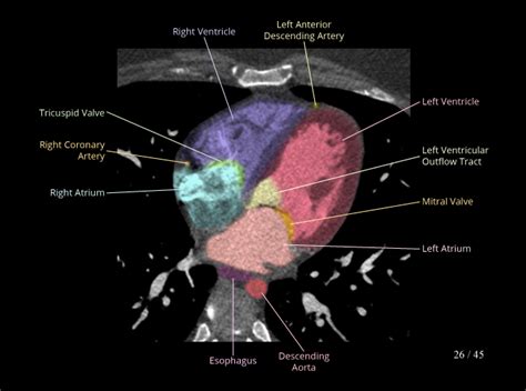 Heart Ct Scan Labeled
