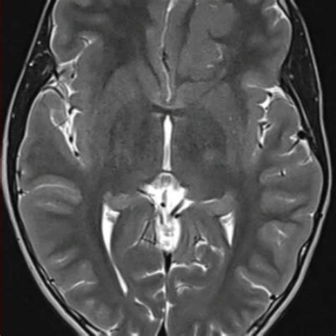 augmented epileptic seizure dataset kaggle