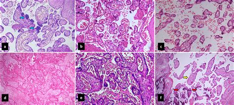 Clinicopathological Audit Of The Placenta In Fetal Growth Restriction Journal Of Laboratory