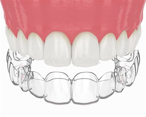 3d Render Of Upper Jaw With Invisalign Removable Retainer Stock Illustration Illustration Of