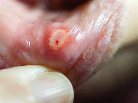 Canker Sore Stages Stages Of Cold Sores And How To Treat Fever Blisters