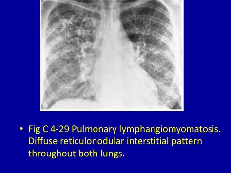 4 Diffuse Reticular Or Reticulonodular Pattern