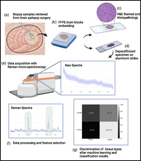 Single Cell Raman Spectroscopy Detects Pediatric Focal Cortical Dysplasia