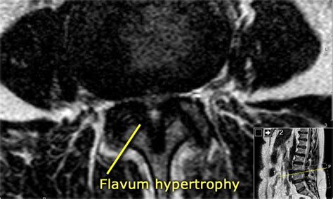 Ligamentation Flavum Buckling