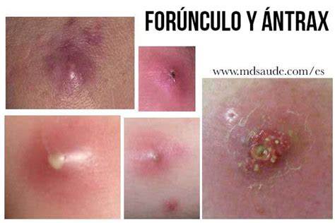 ForÚnculo Causas Síntomas Y Tratamiento • Md Saúde Home Healthcare