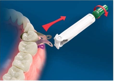 Circumferential Vs Sectional Matrix Bands
