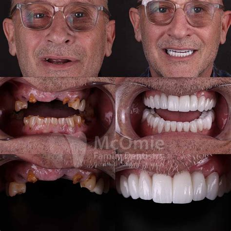 What Is Full Mouth Dental Reconstruction At Mitchell Fredricksen Blog