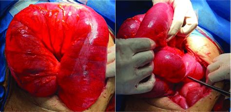 Transverse Colonic Volvulus Appearance At Laparotomy Download Scientific Diagram