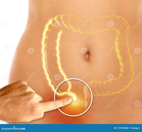 Appendicitis Inflammation Of The Appendix Colon The Illustration On