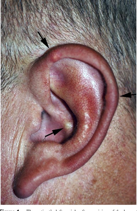 Auricular Tophi As The Initial Presentation Of Gout Semantic Scholar