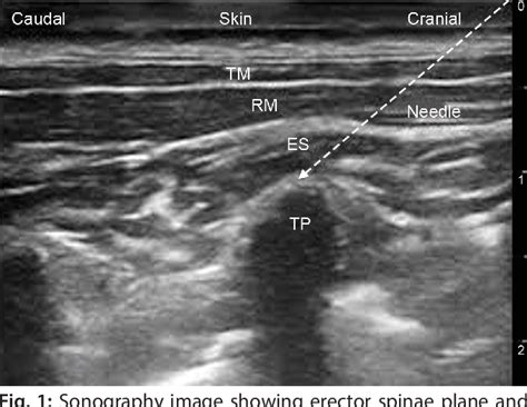 Figure 1 From Bilateral Erector Spinae Plane Block For Breast