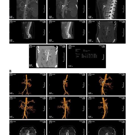 Michel S Classification Of The Hepatic Arteries Download Table