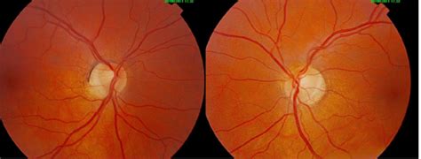 Abnormal Optic Disc Flashcards Quizlet
