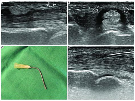 Pulley Thumb Ultrasound At Juan Maguire Blog