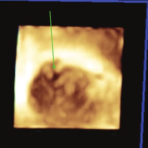 Three Dimensional Echocardiogram Image From Case 2 Demonstrating The