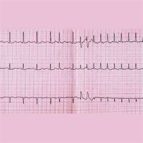 Ectopic Atrial Tachycardia Ecg