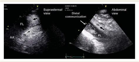 Table 1 From Impact Of Contrast Enhanced Echocardiography On The Diagnostic Algorithm Of Acute