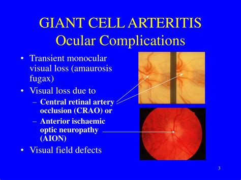 Ppt Giant Cell Arteritis Temporal Or Cranial Arteritis Powerpoint