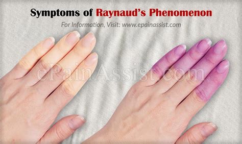 Raynauds Phenomenontypessymptomscausestreatmentprognosis