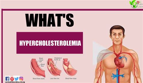 Hypercholesterolemia Definition Causes