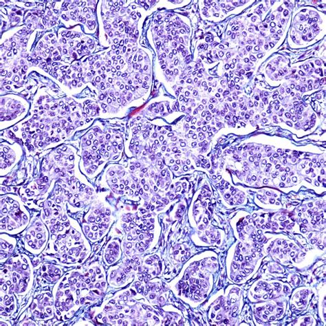 Sternal Bone Trabeculae Spongy Bone Debris Deformed Absent