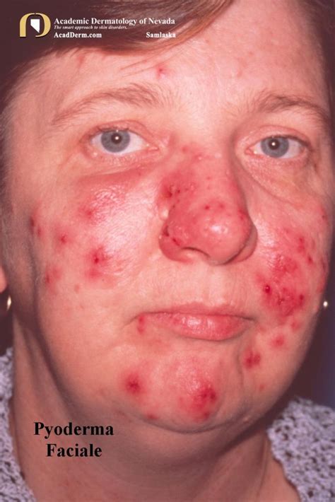 Rosacea Fulminans