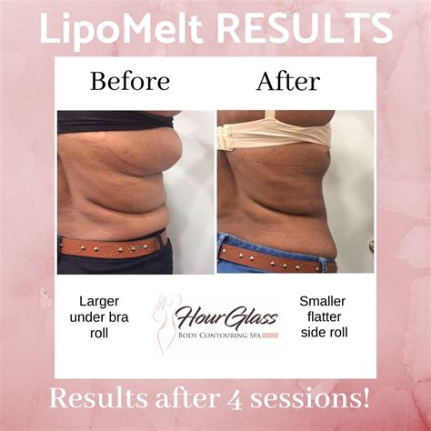 Fateraser Hourglass Body Contouring Spa Medical Weight Loss And