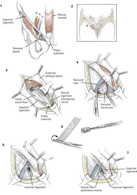 Femoral Hernia Male