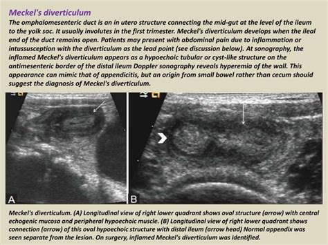Presentation1 Pptx Ultrasound Examination Of The Appendix Pptx