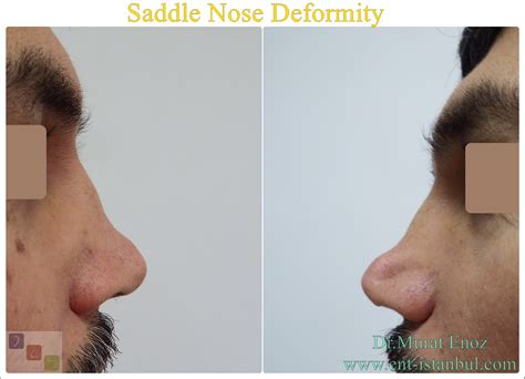 Saddle Nose Deformity Understanding Causes Diagnosis And Treatment