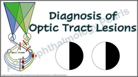 Diagnosis Of Optic Tract Lesions Youtube