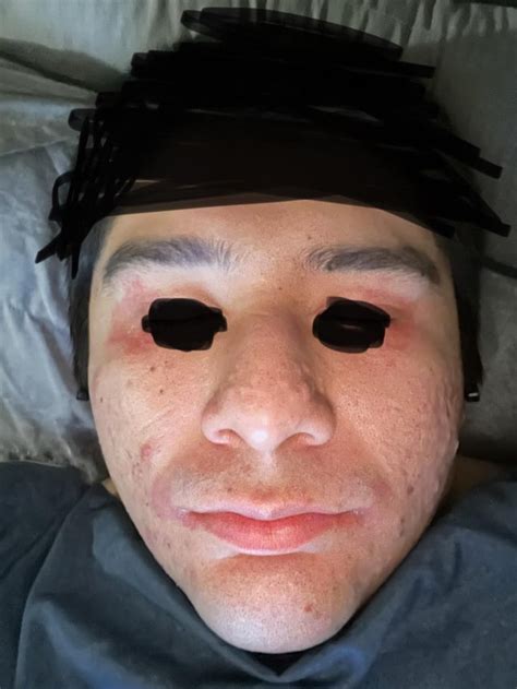 Benzoyl Peroxide Burn Rskincareaddiction