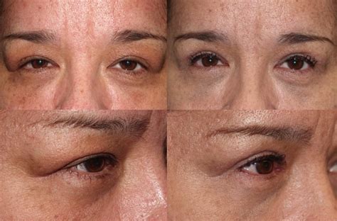 Lacrimal Gland Repair Dr Guy Massry