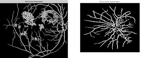 Blood Vessel Segmentation Using Curvelet Transform Based Normalized