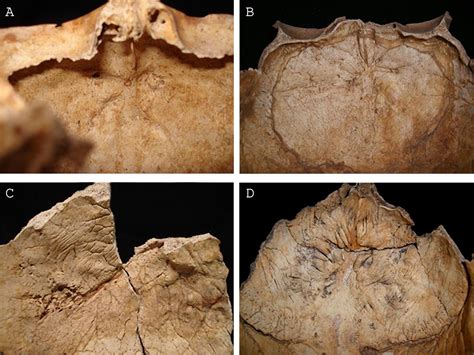 40 Facts About Hyperostosis Frontalis Interna