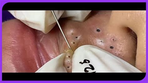 Satisfying Blackheads Removal Pimple Popping Blackheads On Skin Youtube