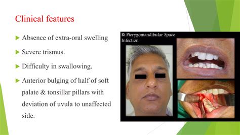 Masticatory Space Infection Pptx