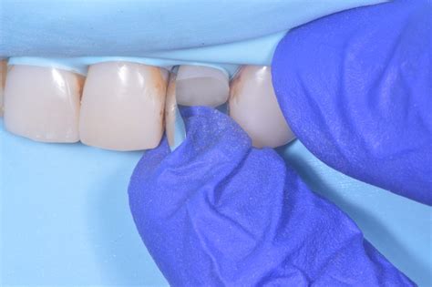 Gergis Size 1 Dme Matrix Brickworks Dental