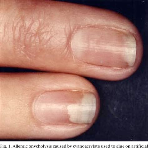 List 92 Pictures Pictures Of Allergic Reaction To Acrylic Nails Superb