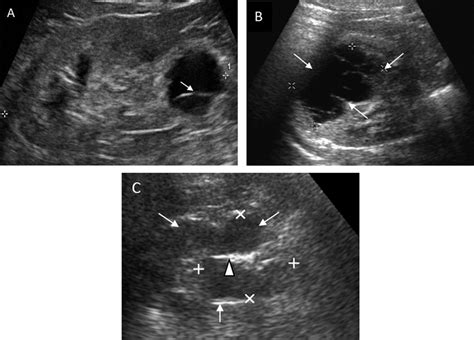Renal Cyst Ultrasound